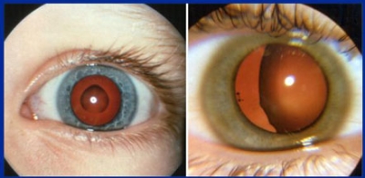 ¿Por qué salen los ojos rojos en las fotos? - Ocularis